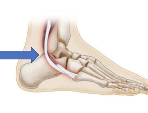 Extensor Tendonitis Foot Tendonitis Explained Dr Justin Dean