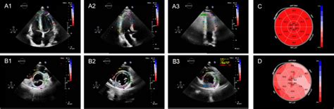 Analysis Of Layer Specific Longitudinal And Circumferential Strain The Download Scientific