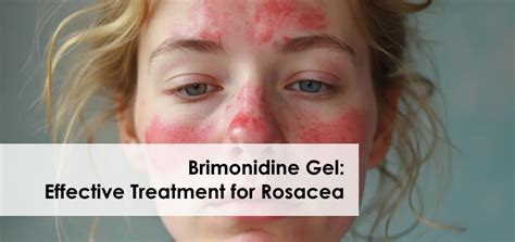 Brimonidine Gel Effective Treatment For Rosacea