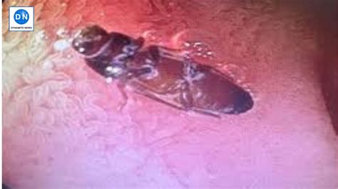 Delhi Doctors Save Mans Life By Removing Live Cockroach From Intestine