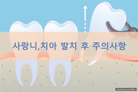 사랑니 발치 후 주의사항 치아 발치 후 주의사항 네이버 블로그