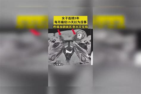 女子连续3年每月痛经15天以为没事疼痛加剧就医查出罕见病 女子