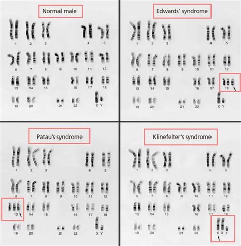 Karyotype Karyotype Test Analysis Normal Karyotype Ab