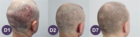 A Guide To Hair Transplants And Donor Area Recovery