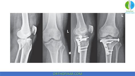 Tibial Plateau Fracture Classification Treatment And Complications