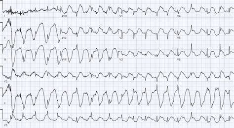 Ecg Artifact And Lead Misplacement Ecg Cases Em Cases