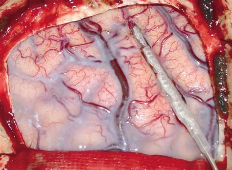 Efficacy Of Electrical Motor Cortex Stimulation Was Approximately 50