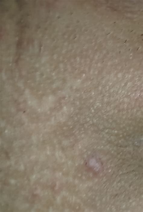 زگیل تناسلی عکس