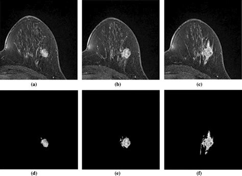 Illustration Of Resultant Lesion Segmentation Obtained By Using The