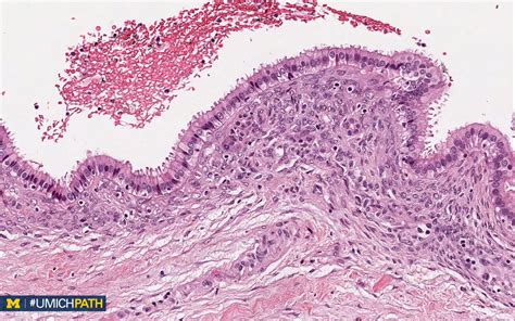 Mucinous Cystic Neoplasm