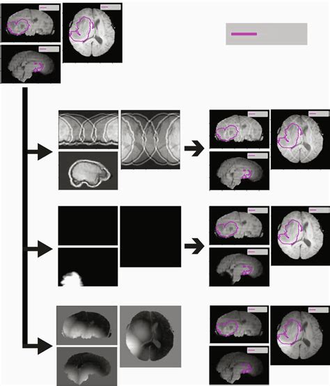 examples of the other acquisition artifacts aliasing signal loss and