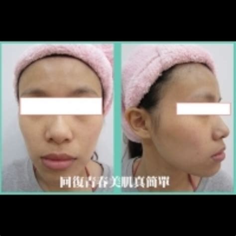 適合亞洲人的超皮秒雷射：解決肌膚痘疤、刺青、斑點等問題 Enews新聞網