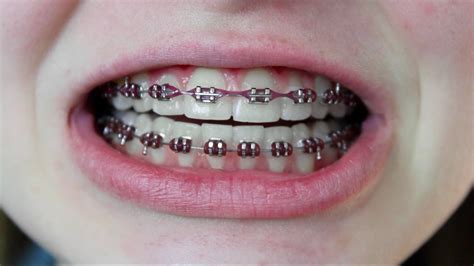 How Do Rubber Bands Hurt On Braces Felisha Nava