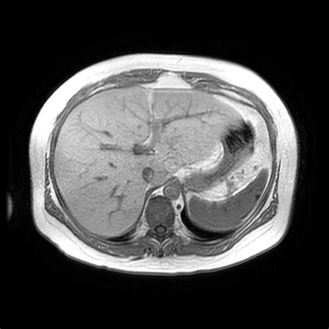 Radiology Cases Diffuse Fatty Infiltration Of The Liver