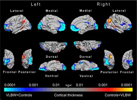 Statistical P Maps Showing Cortical Regions With Significant Download Scientific Diagram
