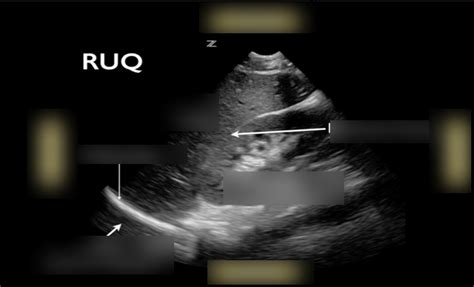 Ruq Ultrasound Diagram Quizlet Ruq Ultrasound Diagram Quizlet