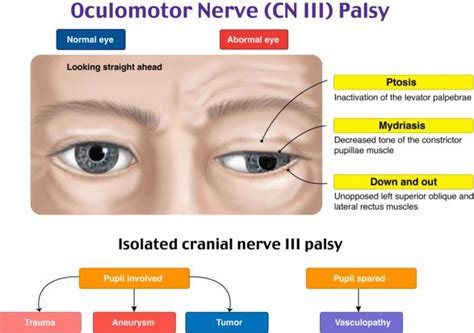 Cranial Nerve Vi The Abducens Nerve Is The Sixth Paired Cranial Nerve… Siddharth Padhiyar Pt