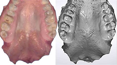 Intraoral Scanning Of Edentulous Arches Lorussoretractors