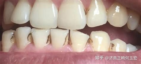 济南牙齿矫正 刷牙出血牙龈肿真的是上火导致的吗 知乎