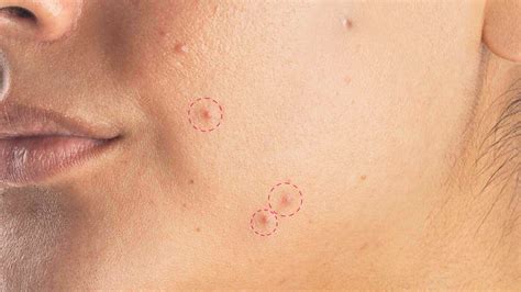 What Do You Do If A Pimple Starts Bleeding Hanhoousa