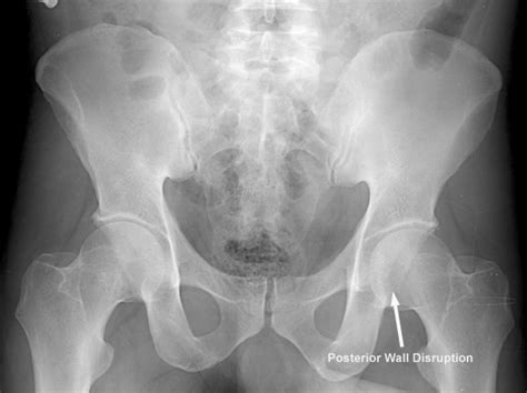 Transverse Acetabular Fracture Aglery