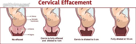 Vector Cervical Effacement And Dilatation During Labor 이미지