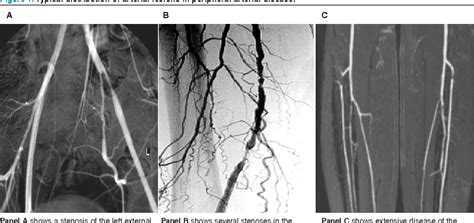 Pathophysiology Diagnosis And Treatment Of Intermittent Claudication My Xxx Hot Girl