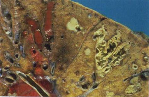 Bronchiectasis Chest