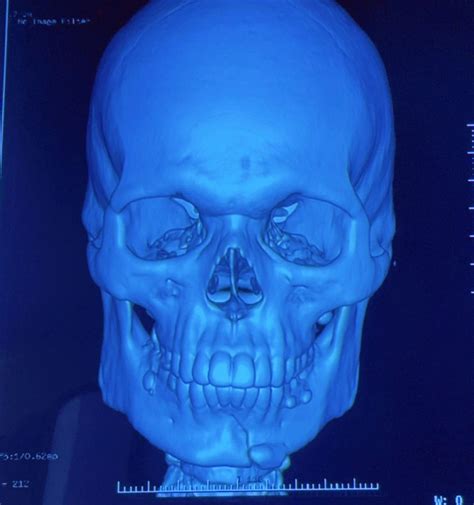 Fracturemandible Orif Surgery Maxfacesurgeon Dr Pawan Dawane