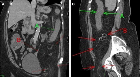 Ischaemic Colitis Secondary To Retroperitoneal Liposarcoma