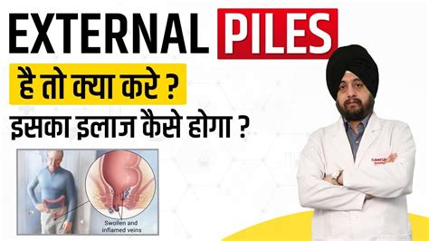 External Hemorrhoids Treatment