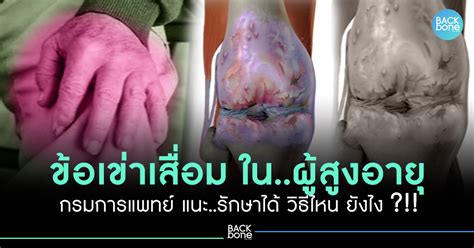 รักษาได้ “โรคข้อเข่าเสื่อม” ผู้สูงวัย กรมการแพทย์ แนะวิธี