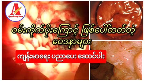 ဝမ်းကိုက်ပိုးကြောင့် ဖြစ်ပေါ်တတ်တဲ့ ဝေဒနာများ ကျန်းမာရေးအသိပညာပေးဆောင်းပါး Ayeyarwaddy Times