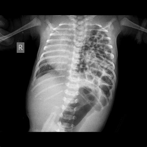 Diaphragmatic Hernia 🫁 Congenital Diaphragmatic Hernia Cdh