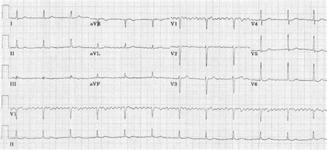 Digoxin Toxicity • Litfl • Ecg Library Toxicology