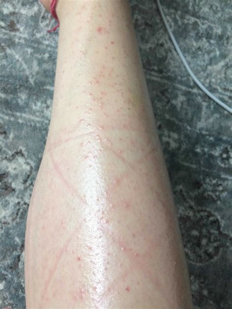 Irritated Hair Follicles Causes Symptoms Diagnosis And Treatment