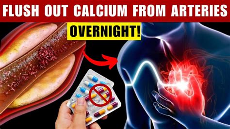 Reverse Soft Tissue Calcification Bring Calcium Out Of Tissue And Into Bones Youtube