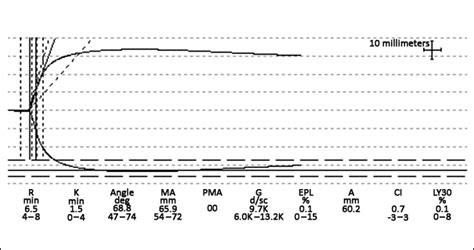 A Normal Thromboelastograph Teg® Tracing In A Patient With Suspected