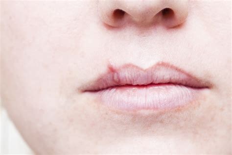 Do Cold Sores Happen On Lips