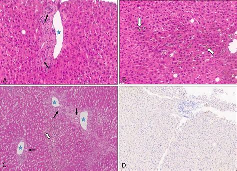 Acute Cholestatic Hepatitis Secondary To Idiopathic Adult Ductopenia