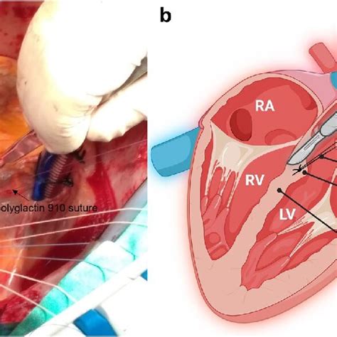Surgical Technique For Concomitant Septal Myectomy A Following