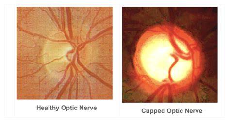 Glaucoma Optic Nerve Cupping The Optic Nerve In Glaucoma Intechopen