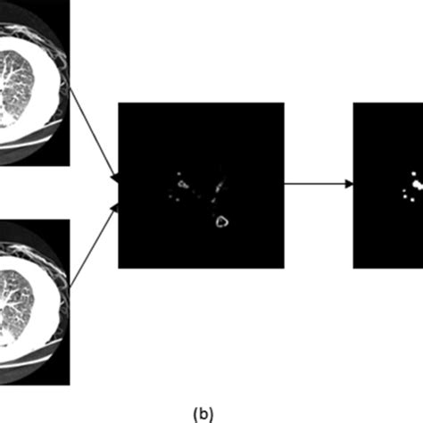 Output Of Candidate Nodule Detection Pipeline On Various Types Of