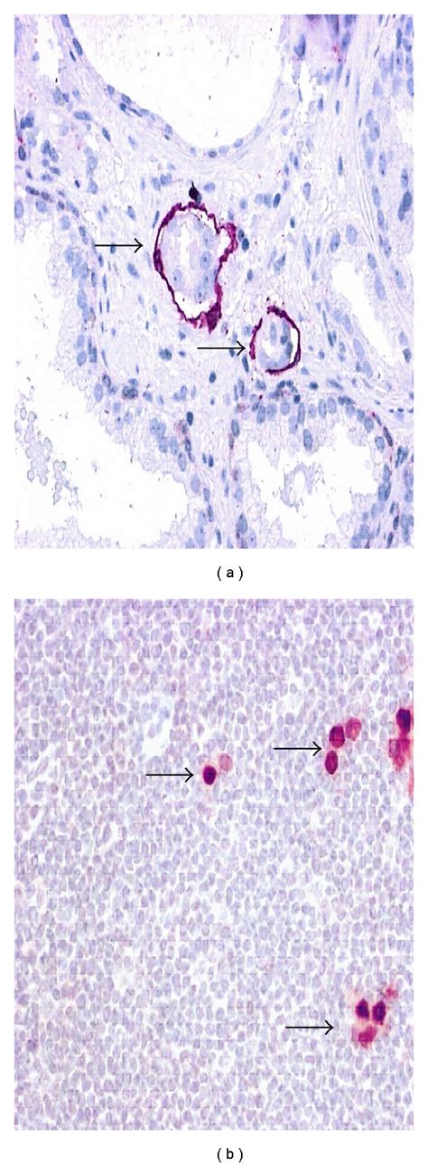 Lymphovascular Invasion Is Detected By The Endothelial Marker D2 40 In