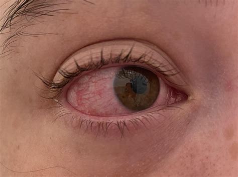 I Was Diagnosed With Episcleritis Repiscleritis