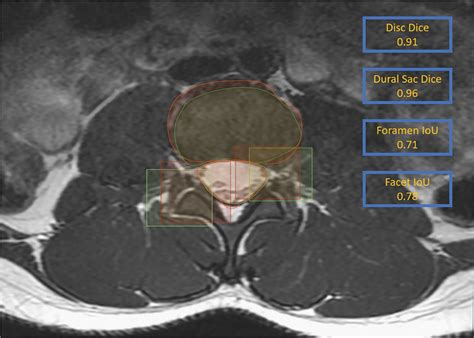 Deep Learning For Automated Interpretable Classification Of Lumbar