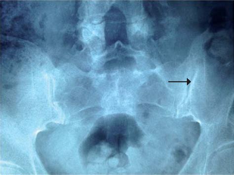 Se Aprecia Esclerosis De Articulación Sacroiliaca Izquierda Fl Echa