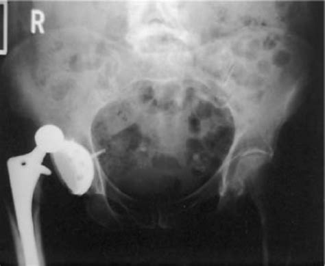 2 An Anteroposterior Pelvic Radiograph Showing A Dislocated Right
