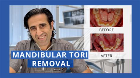 Mandibular Tori Removal Archives Cosmetic Dentist Chevy Chase Md