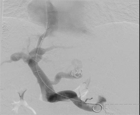 齐鲁医院放射科介入团队应用tipss技术成功救治一例肝癌伴门脉高压消化道出血病例